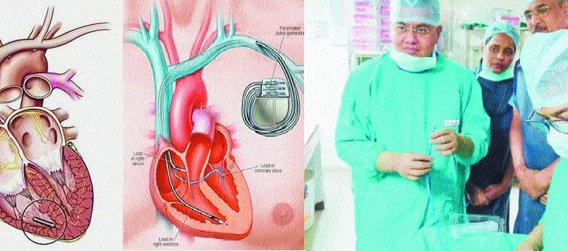 82-year-old man first from Central India to get pacemaker implanted | 2018