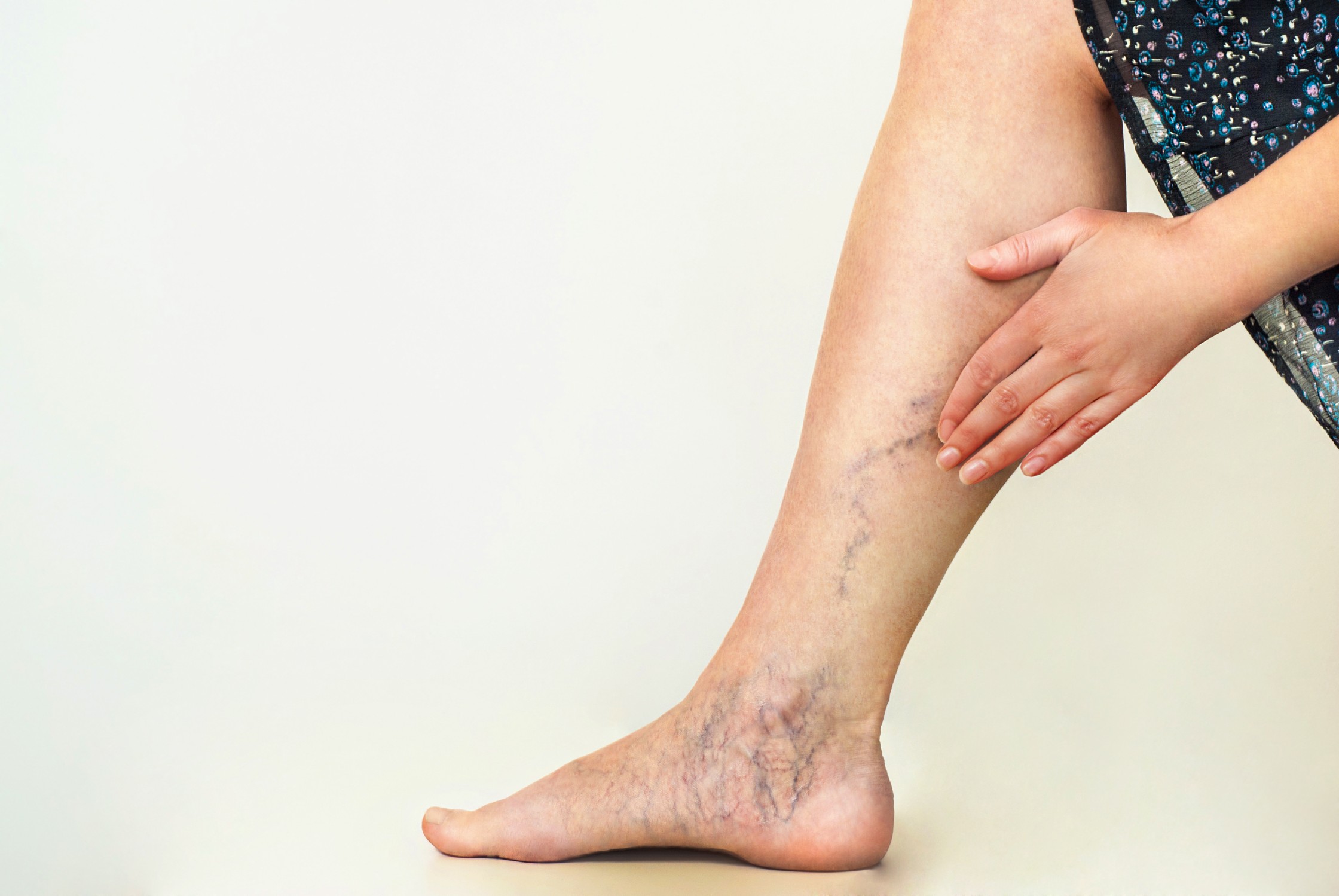 Varicose vein | Wockhardthospitals