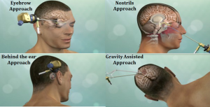 Benefits of Keyhole Brain Surgery | Wockhardt Hospitals