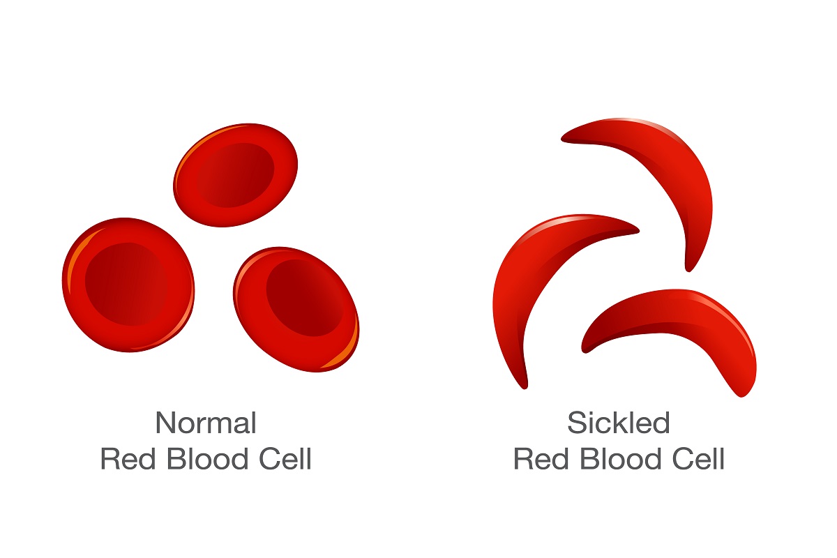 Sickle Cell Disease - Wockhardt Hospitals