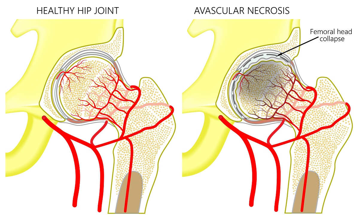 Osteonecrosis Of The Hip