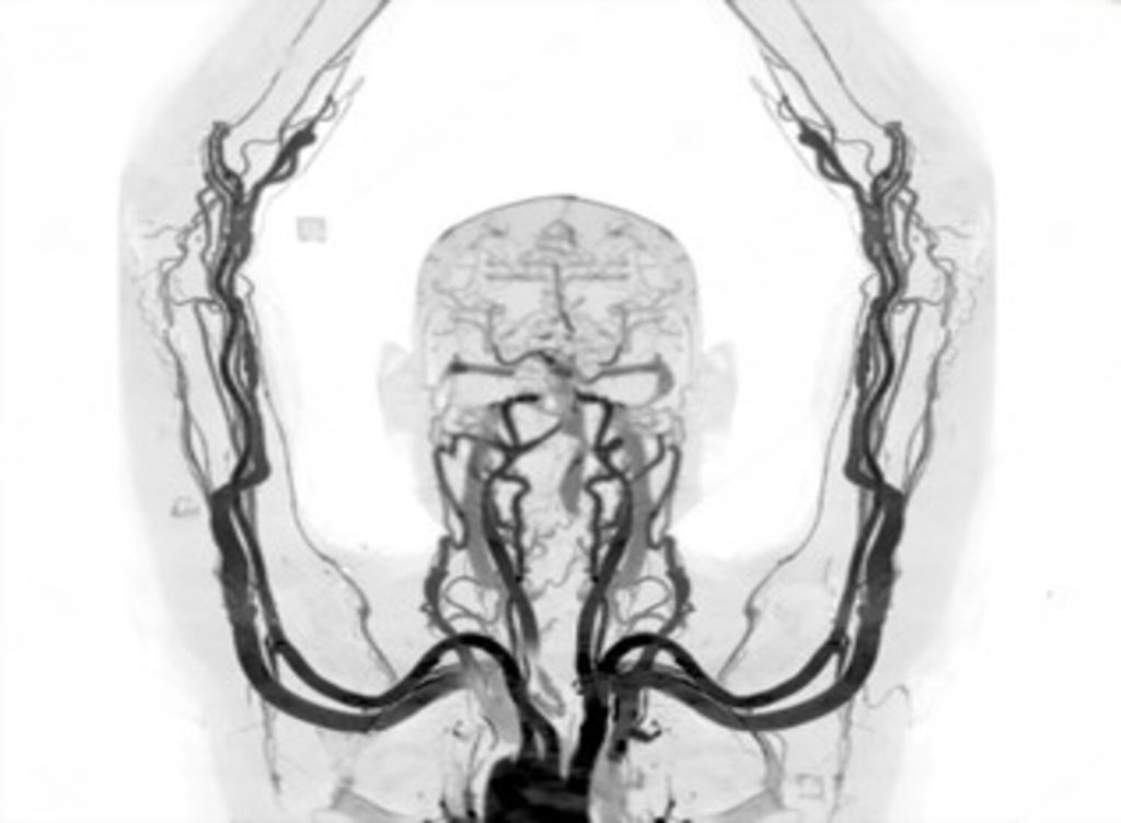 Arteriovenous Malformation (AVM) Treatment & Surgery in India ...